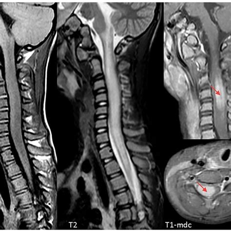 Cervical Magnetic Resonance Imaging Mri At Clinical Onset