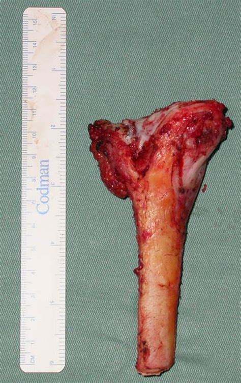 Ewing Sarcoma Of The Tibia Oncosurgery
