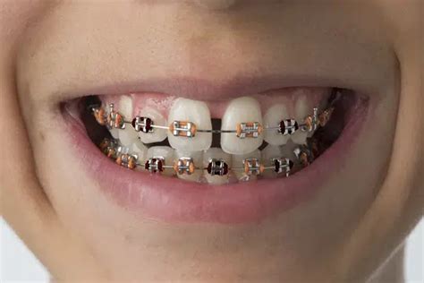 All Braces Colors