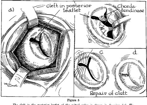 Figure 5 From Congenital Mitral Insufficiency With Cleft Posterior Leaflet Semantic Scholar