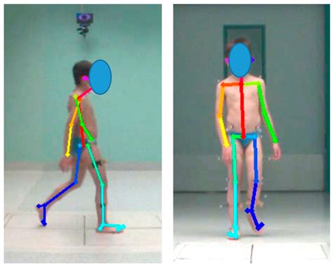 Comparing The Accuracy Of Markerless Motion Analysis And Optoelectronic