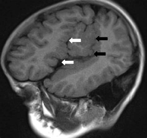 Sagittal T1 Weighted Image Shows Polymicrogyria As Cobblestone Serrated Download Scientific