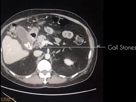 Ct Image Showing Gall Stones And Surround Peri Gall Bladder Fat