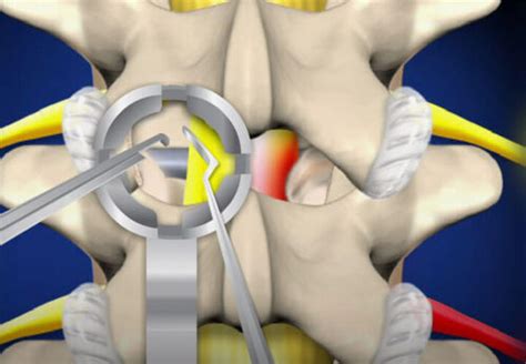 Spine Surgery Videos Dr David Schwartz Orthoindy Back Doctor