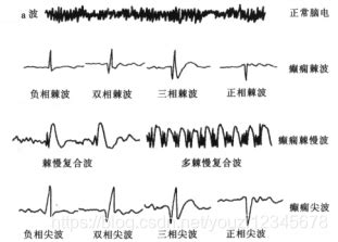 癫痫、脑电图 Csdn博客
