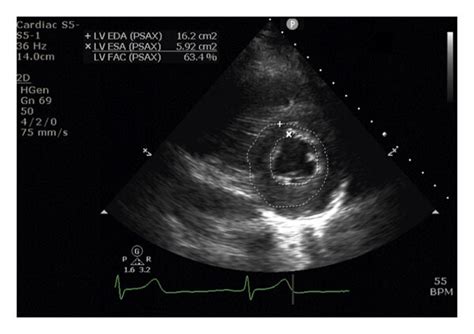 A Measurements Of Left Ventricular Chamber Size And Wall Thickness