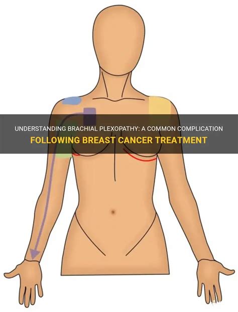 Understanding Brachial Plexopathy A Common Complication Following Breast Cancer Treatment Medshun