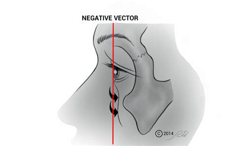 9 Negative Vector Eye Images Negative Vector Eye Surgery Negative