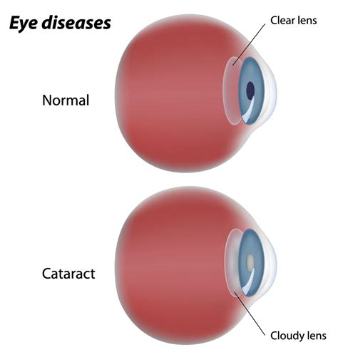 Gallery Glaucoma Associates Of Texas