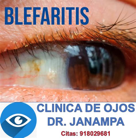 La Blefaritis Se Produce Cuando Oftalmología Janampa