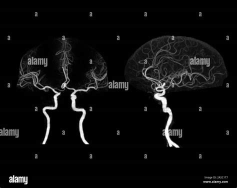 Ct Angiography Of The Brain Or Cta Brain Showing Cerebral Artery Stock