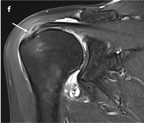 Integrating Tendinous Pathophysiology Into Rotator Cuff Tears And