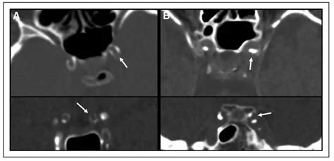 颈内动脉颅内段钙化与血管内卒中治疗疗效：mr Clean亚组分析 脑医汇