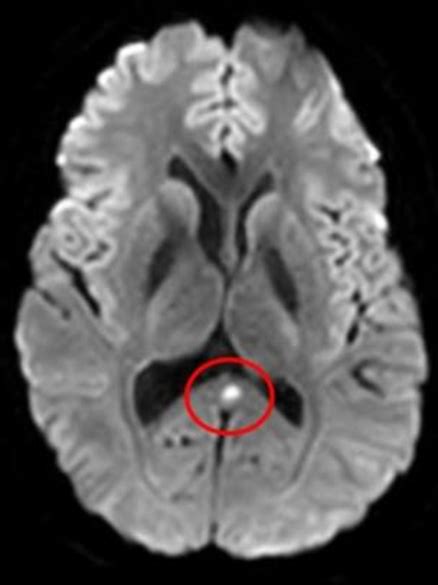 Dwi Mr Image Shows A Small Round Area In The Splenium Of Corpus Download Scientific Diagram