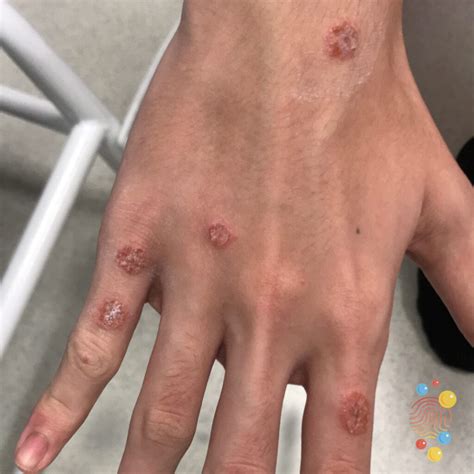Eczema Numular Drug Induced Nummular Dermatitis Hoogstra Medical