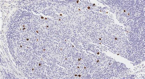 Classic Hodgkin Lymphoma Ottawa Atlas Of Pathology