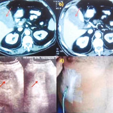 A B Enlarged Gallbladder With Hematoma Without Stone C Gallbladder
