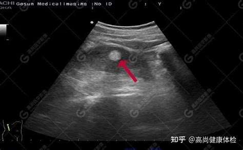 体检发现肾错构瘤，肾错构瘤是良性吗？严重吗？ 知乎