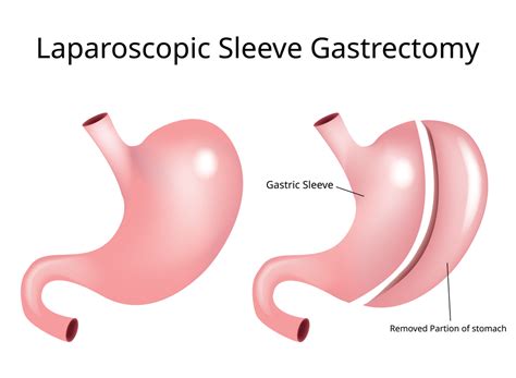 Sleeve Gastrectomy Procedure And All About It Healing Clinic Turkey
