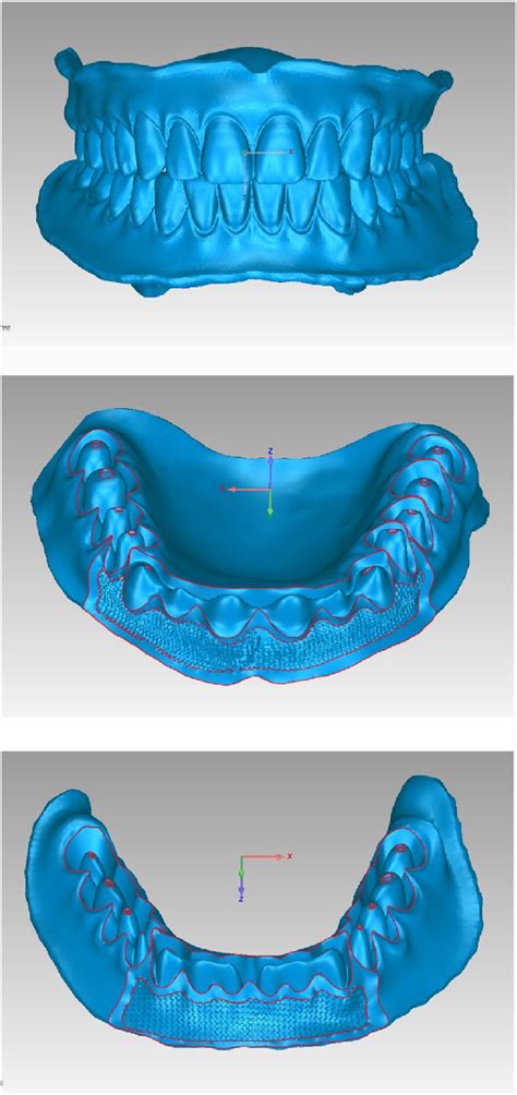 Design Of Digital Complete Dentures And Base Plates A Digital