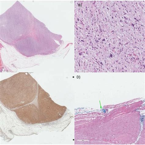 Homogonous Hypoechoic Lesion Anterior To The Left Hepatic Lobe Color
