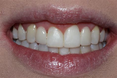 Excel Dental Straight White Healthy Teeth