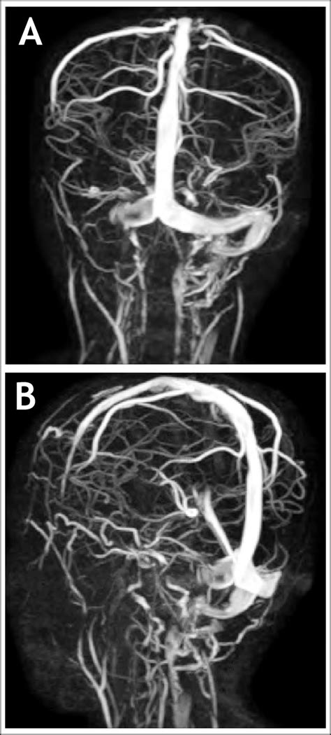 A And B Posterior And Lateral Mrv Images Showing Cerebral Venous Sinus Download Scientific