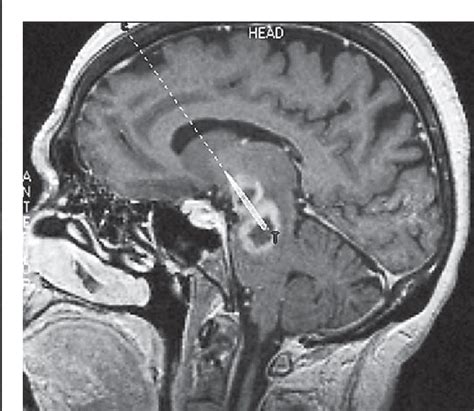 Figure 2 From Stereotactic Biopsy For Brainstem Tumors Comparison Of Transcerebellar With