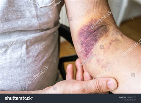 Internal Bleeding Bruises