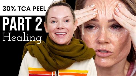 Part 2 Tca Recovery Post Care After Chemical Peel Before And After