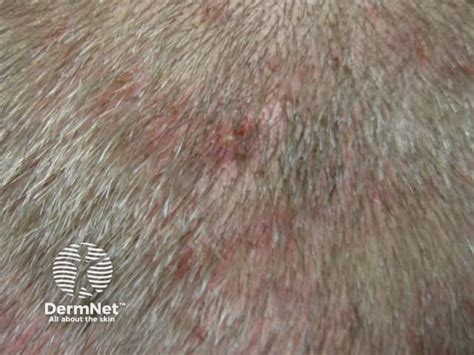 Red Bumps On Scalp