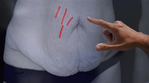 Remove Stretch Marks With A Tummy Tuck Real Results Video Realself