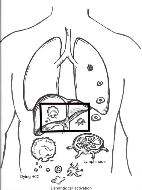 Abscopal Effect Demonstrating The Activation Of The Immune System After
