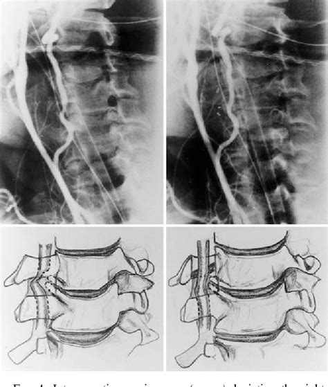 Figure 4 From Rotational Occlusion Of The Vertebral Artery Caused By