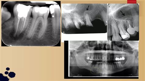 Chronic And Subacute Osteomyelitis Odp
