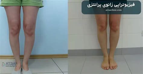 فیزیوتراپی زانوی پرانتزی معرفی بهترین کلینیک و دکتر
