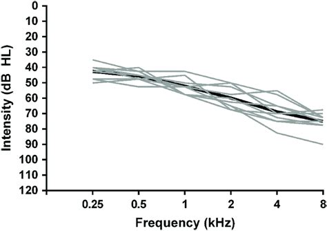 Audiogram Of The Ear Having Tinnitus From The Participants Of The Study