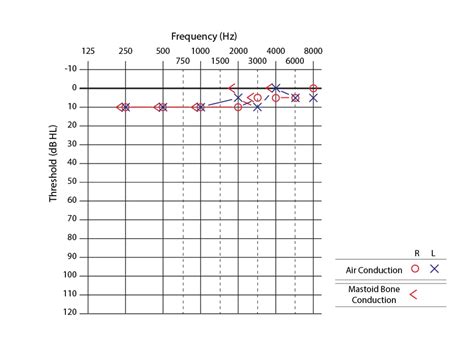 Image Audiogram Of Right Ear In A Patient With Normal Hearing Msd