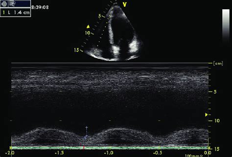 Right Ventricle Systolic Dysfunction Estimated Using Tricuspid Annular Download Scientific
