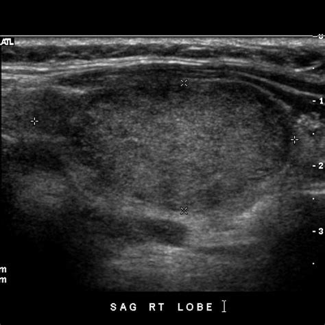 Radiopaedia Case Thyroid Nodule Autonomous Id 9560 Study 10216 Nc