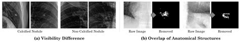 Anatomic Feature Fusion Model For Diagnosing Calcified Pulmonary