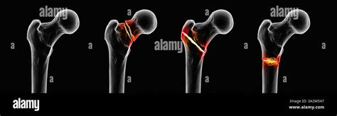 Types Bone Fractures Banque De Photographies Et Dimages à Haute