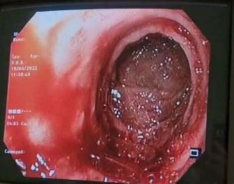 Dieulafoys Lesion Active Bleeding From The Duodenum Download