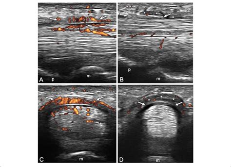 Longitudinal Ab And Transverse Cd Scans Of The Annular Pulley