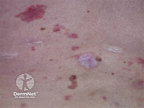 Basal Cell Nevus Syndrome