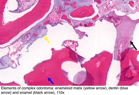 Pathology Outlines Odontoma