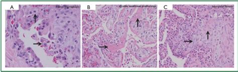 Severe Amiodarone Induced Pulmonary Toxicity Pmc