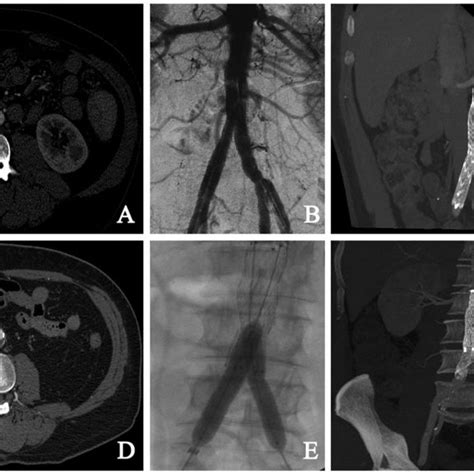 Svensson Classification 6 I Classic Aortic Dissection With Intimal Download Scientific