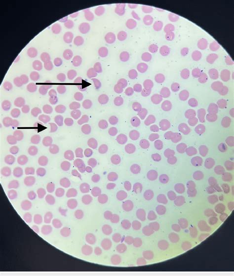 A Peripheral Smear Revealing Schistocytes Black Arrows With Few