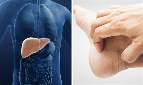 Fatty Liver Disease Itching In The Hands And Feet May Worsen At Night